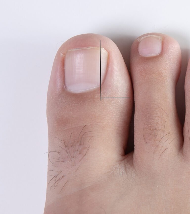 Tratamiento definitivo de uña encarnada